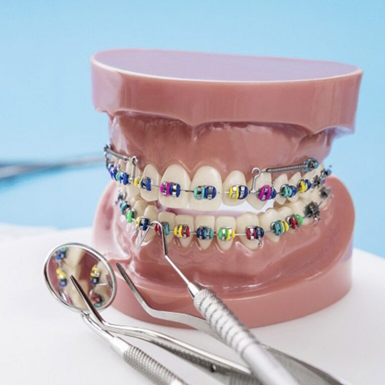 Aparelhos Ortodônticos » Sorriso Prime Odontológia - Seu Dentista em Manaus